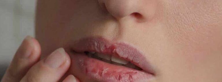 Tratamientos rápidos para curar calenturas en los labios